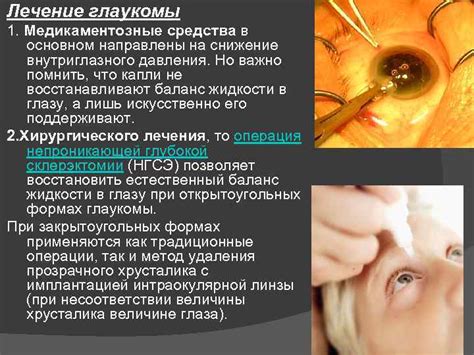ГЛАУКОМА Выполнила студентка