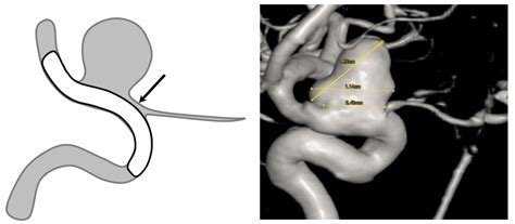 Pipeline Device Aneurysm Selection