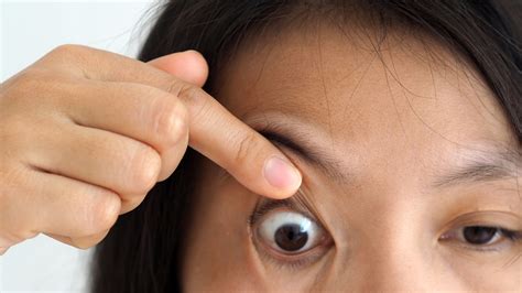 Signs Of Cellulitis In The Eye Onlymyhealth