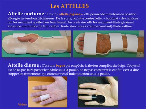 Trigger Finger Splint Trigger Finger Splint Trigger Finger Splint Denis Gerlac Rééducation