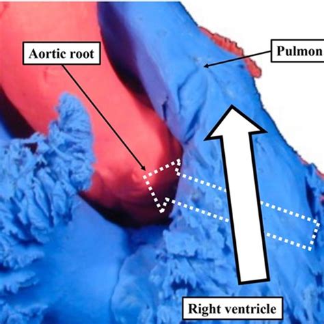 The Casts Show The Ventricular Outflow Tracts From A Normal Heart With