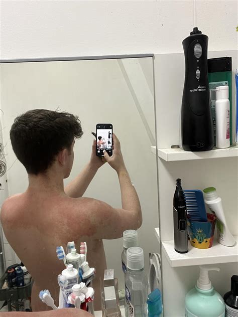 Help When Treated With Steroid Cream It Just Spreads And Gets Worse I Dont Know What To Do