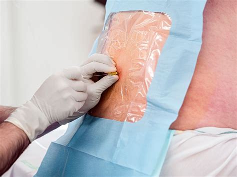 Signs And Symptoms Indicating You Have An Epidural Abscess