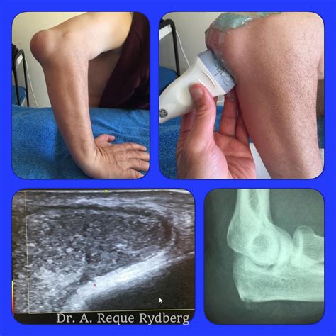 Consciente Coro Dormitorio Bursitis De Codo Pecador Falso Rústico