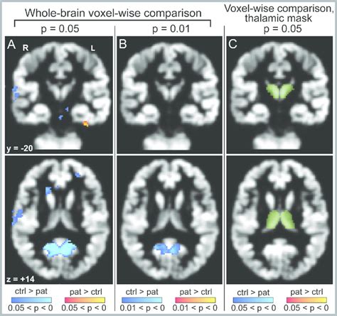 Voxel Based Morphometry In Cervical Dystonia Voxel Based Morphometry Download Scientific