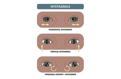 Nystagmus Treatment