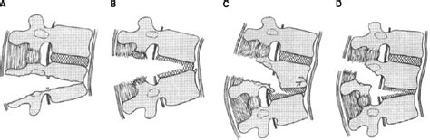 Flexion Distraction Fracture