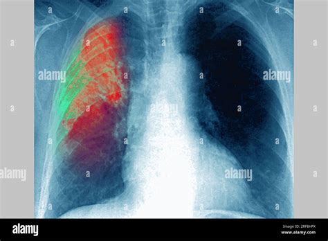 Pneumonia In A Right Lung Acute Respiratory Infection Revealed By Frontal Chest X Ray Stock