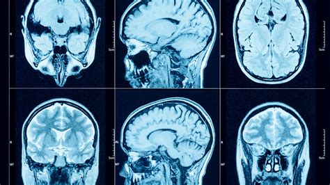 Aussie Breakthrough In Diagnosing Multiple Sclerosis Yourlifechoices