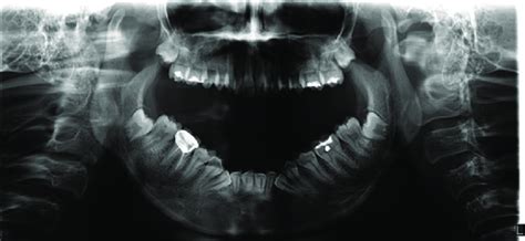 Preoperative Orthopantomograph Showing Bilateral Dislocation Of The