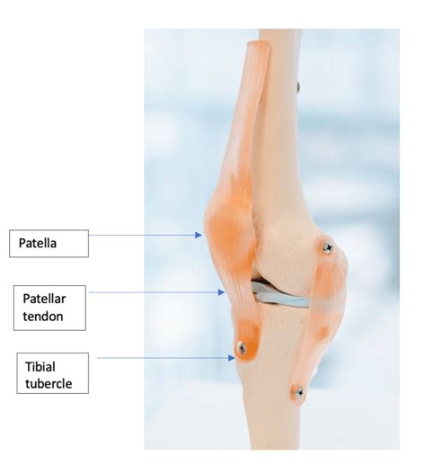 Tibial Tubercle Osteotomy Knee Cap Surgeon London Expert Knee Clinic