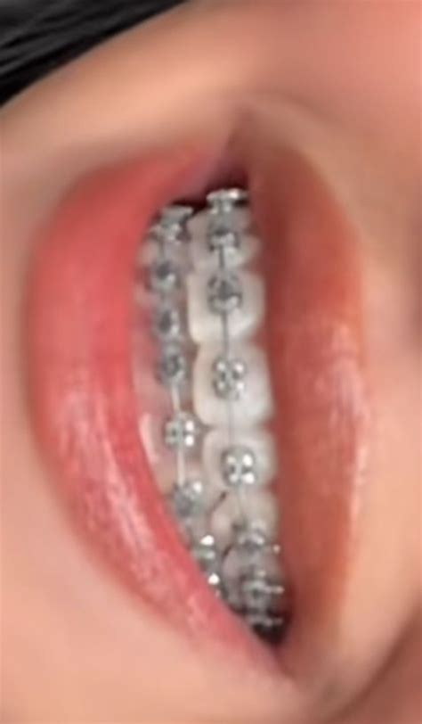 Gray Braces A Stunning Smile Transformation In 2025