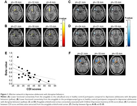 Affective Network And Default Mode Network In Depressive Adolescents W Ndt