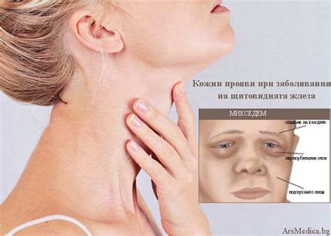 Кожни прояви при заболявания на щитовидната жлеза Arsmedica Bg Wearable Fashion Fitbit