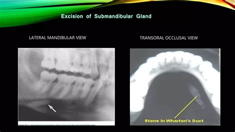 Submandibular Gland Excision Pptx