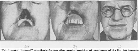Figure 1 From Surgery And Prostheses Semantic Scholar