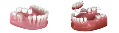 Dentures Vs Bridges Which Is A Better Option Teeth Wisdom