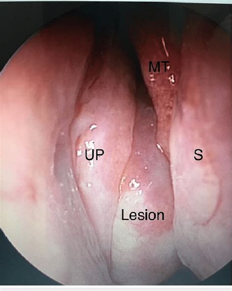 Endoscopic View Of The Lesion Up Uncinate Process S Septum Mt Download Scientific Diagram
