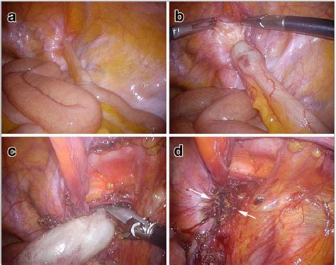 Reduction Of The Incarcerated Appendix A Appendix Incarcerated In The