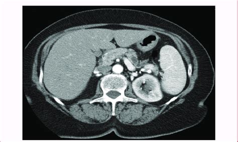CT showing an intraductal papillary mucinous neoplasm of the pancreatic ...