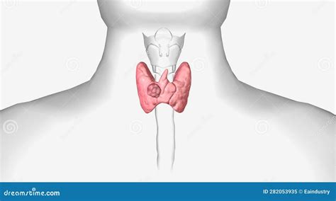 Thyroid Nodules Are Solid Or Fluid Filled Lumps On The Surface Of The Thyroid Gland Stock