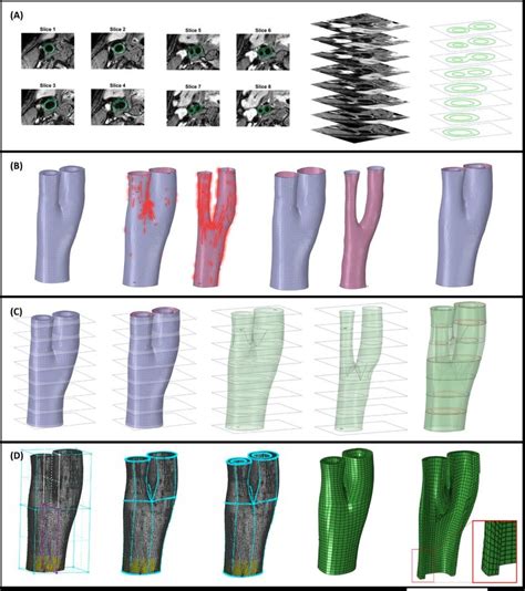 A Delineation Of Vessel From T2 Weighted Mri Images And Creation Of