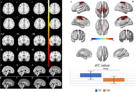Comparison Of Differences Between Intra Network Functional Connectivity