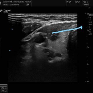 Us Showing Suspicious Thyroid Nodule Download Scientific Diagram