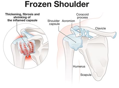 What Is Frozen Shoulder Dr Eric Giang