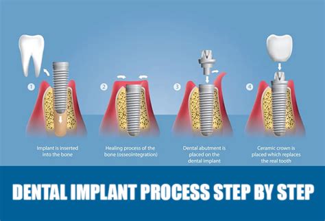 Dental Implant Procedure In Singapore Ashford Dental