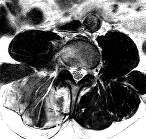 Facet Synovitis Radsource