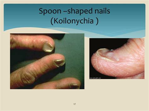 Spoon Nail Explanation At Indiana Houlding Blog