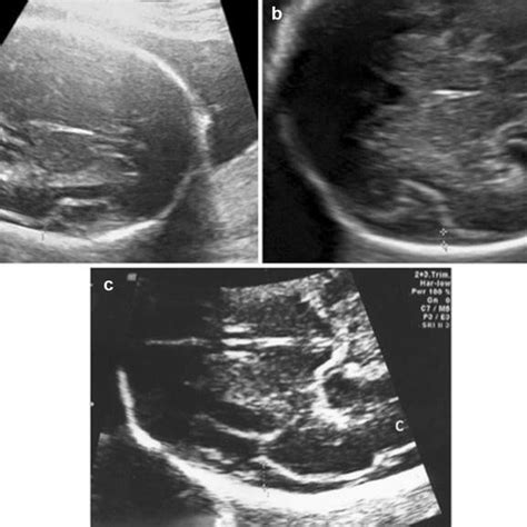 Sinocortical Width Is Demonstrated In Coronal Plane Download