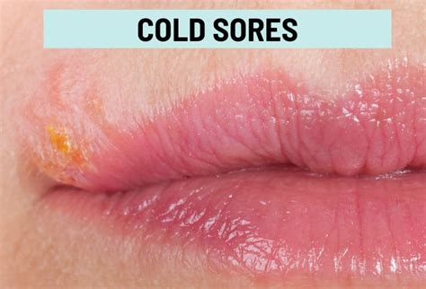 Mouth Pimple Sore At Anne Nelson Blog