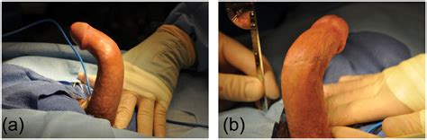 Update On Plication Procedures For Peyronies Disease And Other Penile