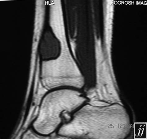 Distal Tibial Cyst Radiopaedia