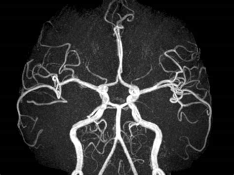 What Is A Mri And Mra At William Woodard Blog