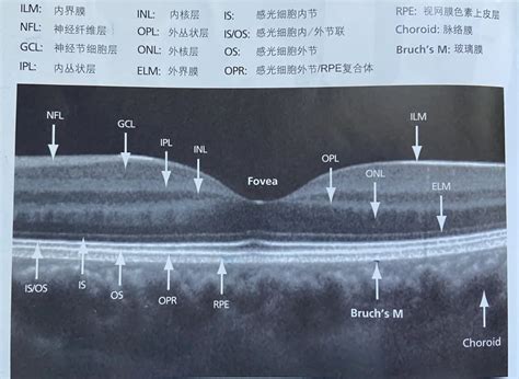 常见oct影像及图像解读 好医术文章 好医术 赋能医生守护生命
