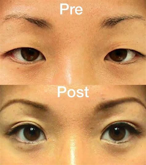 Asian Blepharoplasty Double Eyelid Surgery Healthtips By Teleme