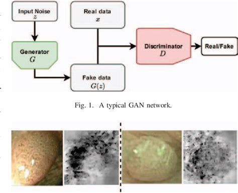 Figure 1 From Improved Endoscopic Polyp Classification Using Gan