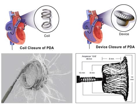 percutaneous patent ductus arteriosus pda closure when and how to