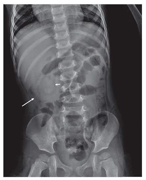 Target Sign Intussusception Abstract Europe Pmc