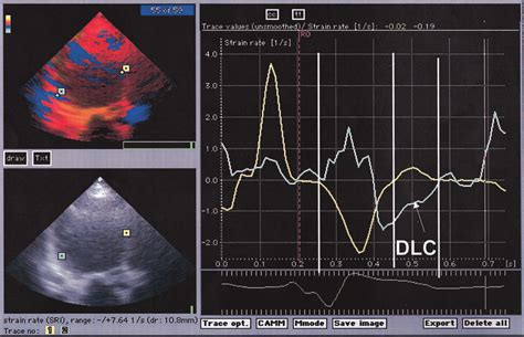 Apical Long Axis View In Patient With Dilated Cardiomyopathy And LBBB Download Scientific