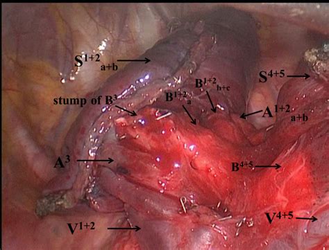 The Remaining Left Upper Lobe Was Divided Into Two Separate Segments Download Scientific