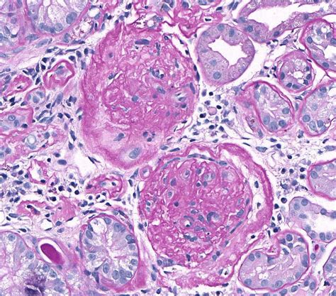 Focal Segmental Glomerulosclerosis Atlas Of Renal Lesions In