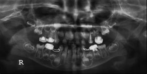 Panoramic Radiography Note The Hypotrophic Dentin And Hypoplastic