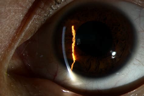 Atlas Entry Iris Melanocytoma