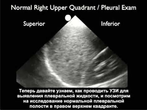 Порядок выполнения: ультразвуковое выявление плевральной жидкости - YouTube