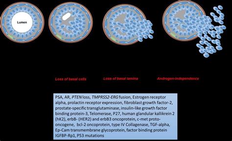 Schematic Representation Of The Development And Progression Of Prostate