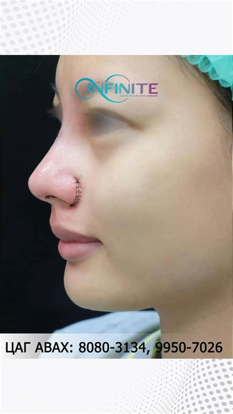 Хамрын нуруу өндөрлөж үзүүр шөнтийлгөх самсаа засах мэс засал Infinite Clinic Арьс гоо